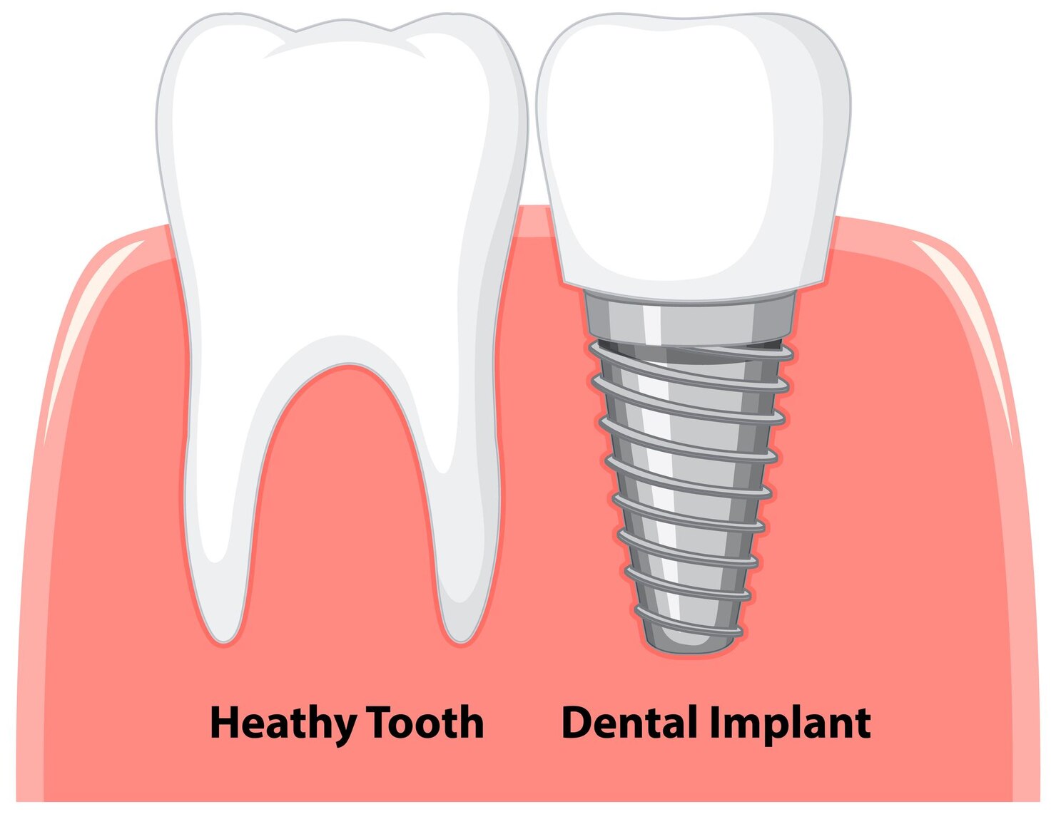 Top Tips for Long-Lasting Dental Implants Care