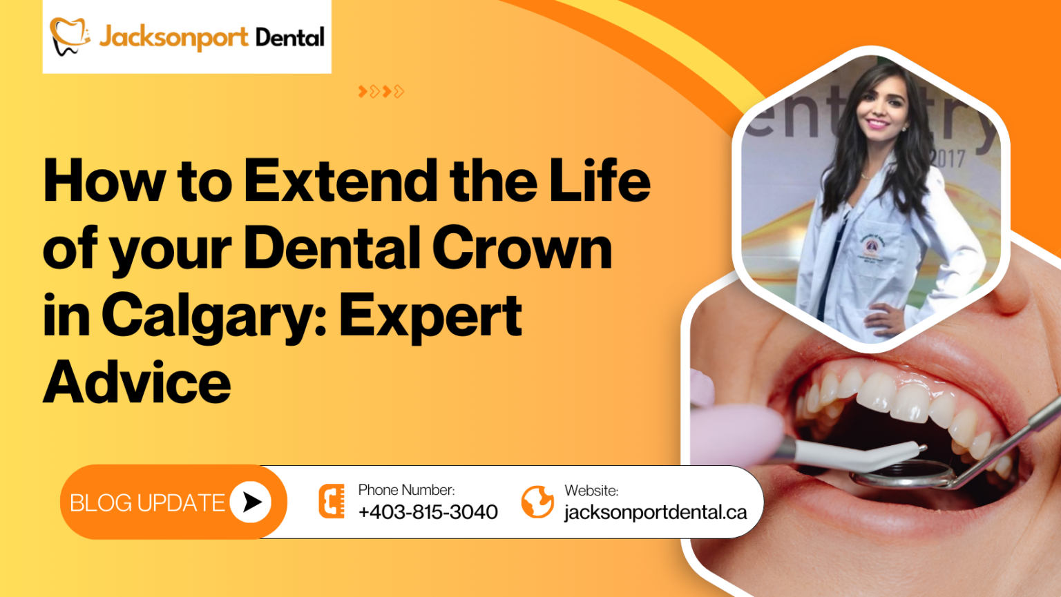 7 tips to extend Life of your Dental Crown in Calgary | Jacksonport