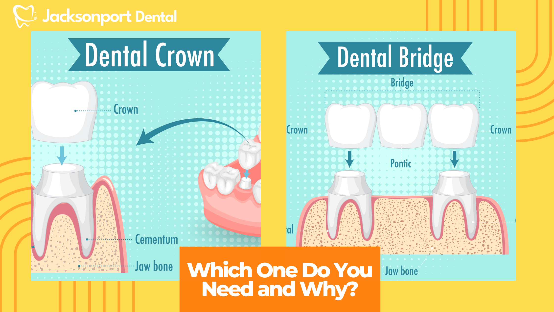 Crowns vs Bridges: Which One Do You Need and Why?